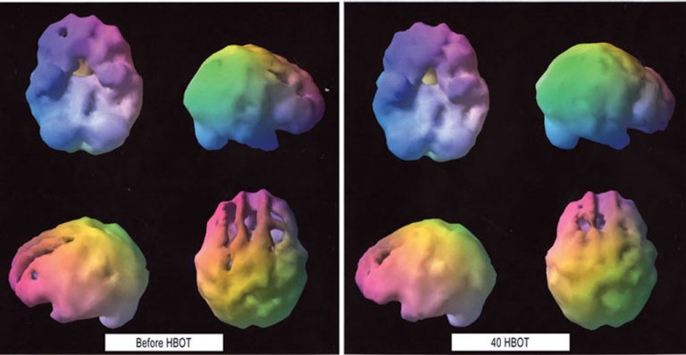 Testimonial Female Dementia Patient - San Diego Center for Hyperbaric ...